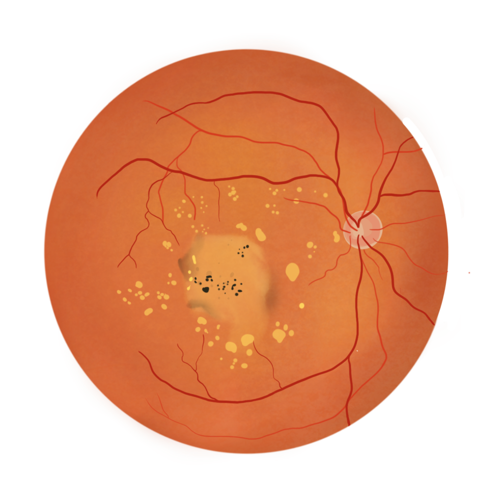 Ophtalmologie DMLA, specialistes à Nantes