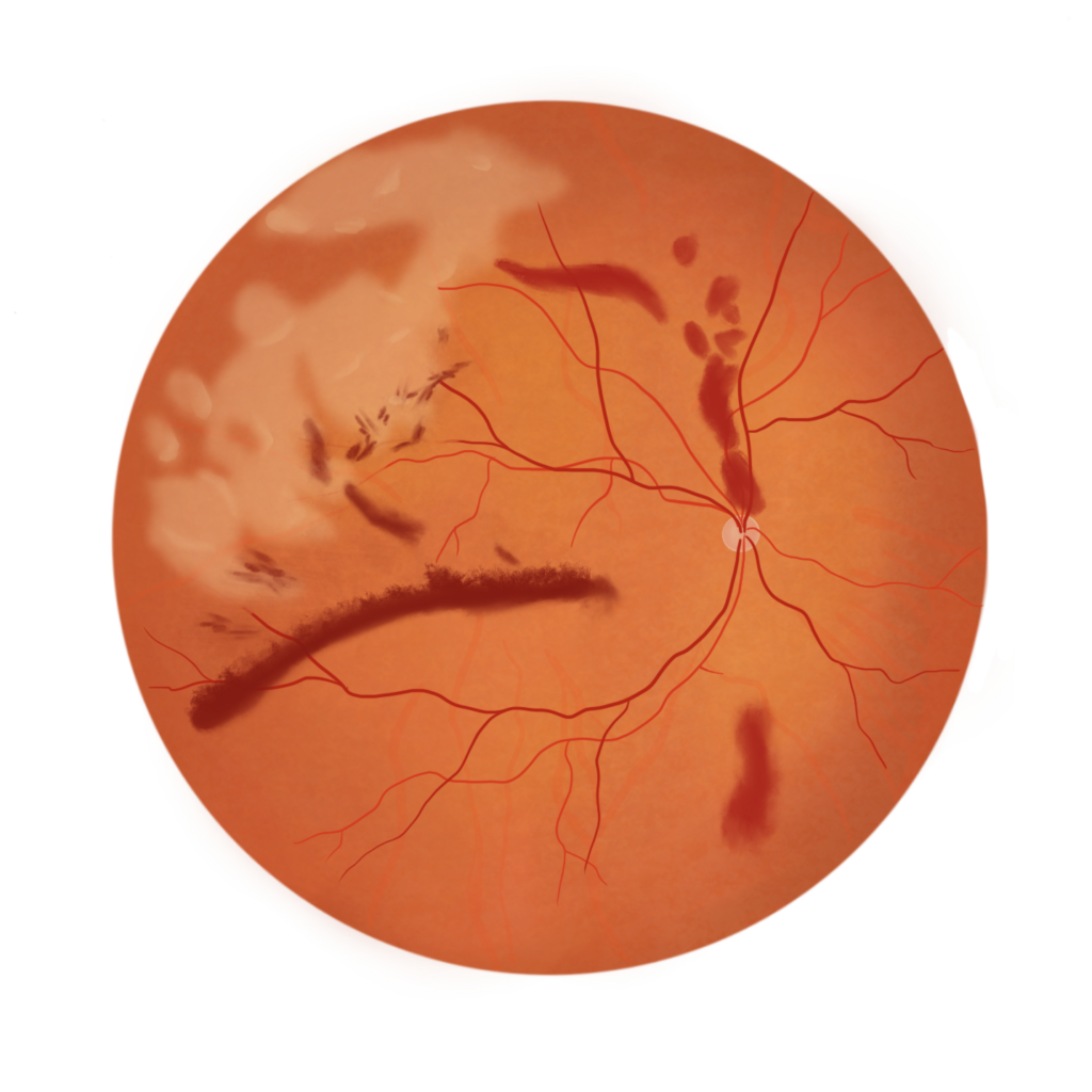 Traumatismes de la rétine et du segment postérieur de l’oeil